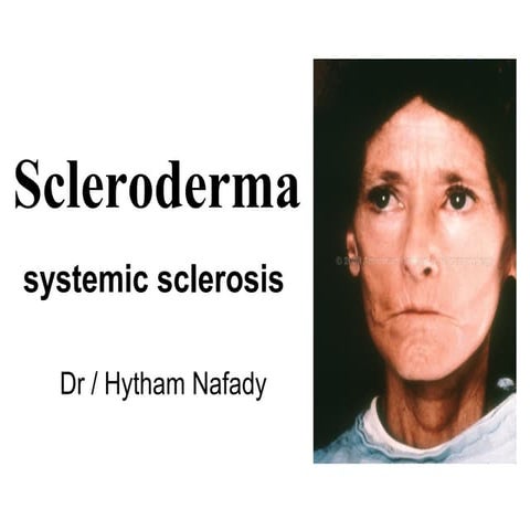 Scleroderma | PPT