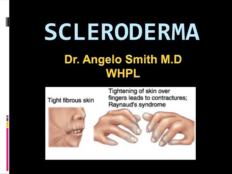 Scleroderma