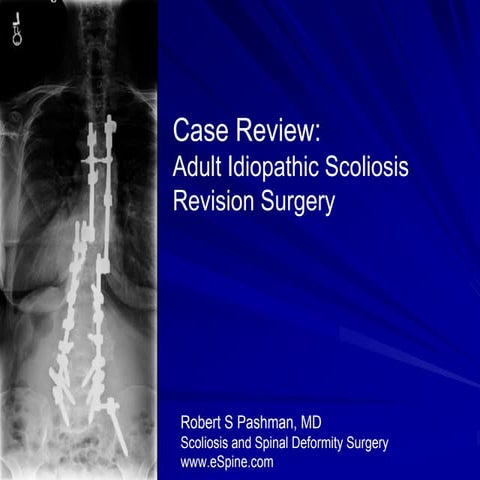Case Review #12: Adult Scoliosis Revision Surgery due to Flatback | PDF