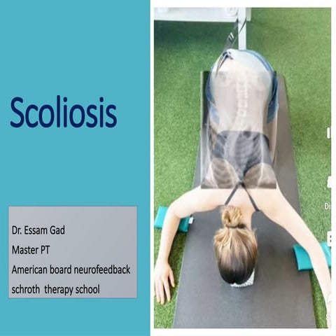 scoliosis 3D management basics by Dr.Essam Gad | PPTX