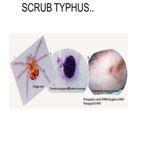 scrub typhus.pptx