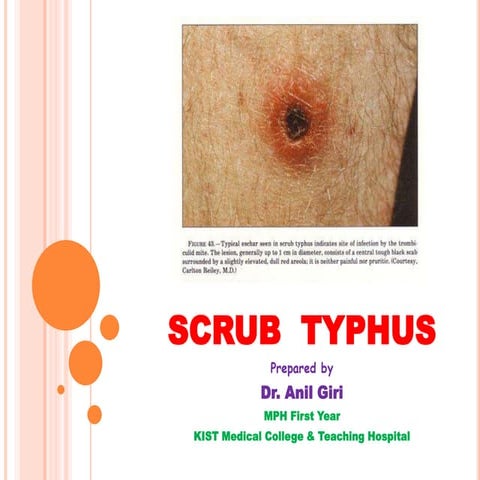 Scrub Typhus 2079 08 05.pptx