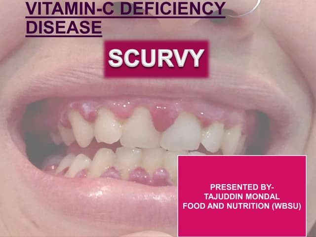 Scurvy | PPTX