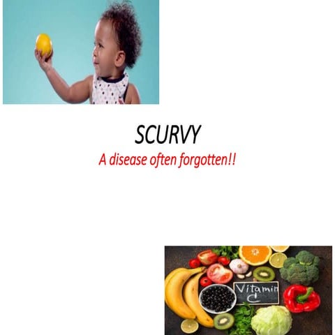 Scurvy in children | PPTX