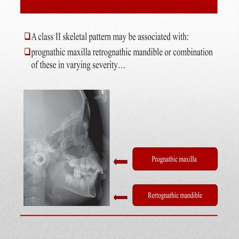 Bimaxillary protrusion treated without extraction | PDF