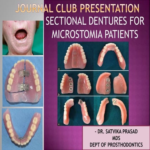 Sectional dentures for microstomia patients.pptx | Oral care | Personal ...