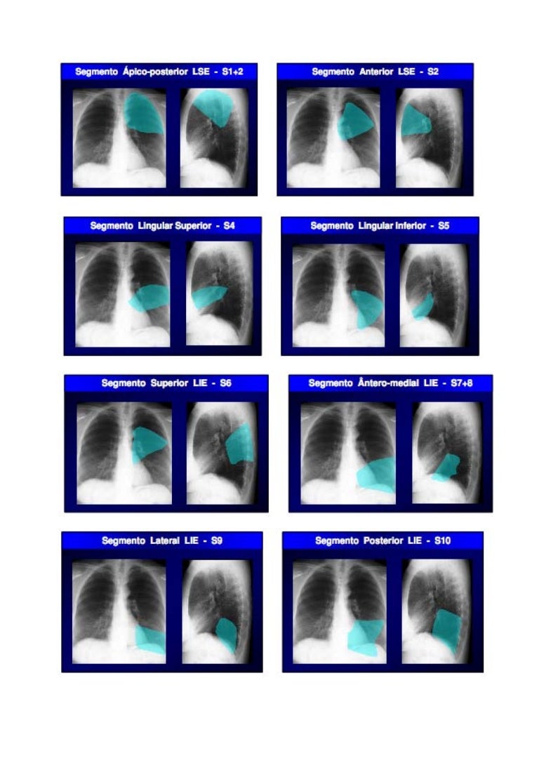 Segmentos do Pulmao Esquerdo ao RX