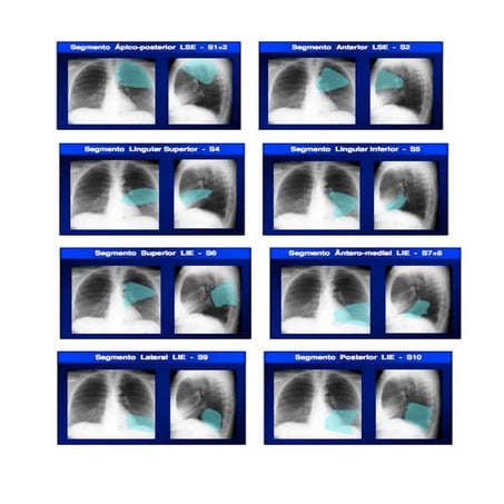 Segmentos do Pulmão Direito ao RX