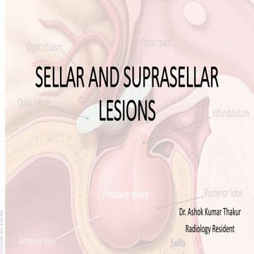 sellar and suprasellar mass pituitary gland .pptx