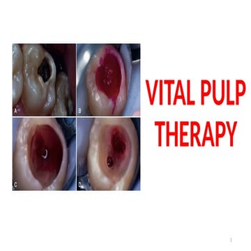 VITAL PULP THERAPY.pptx conservative dentistry and endodontics | PPTX