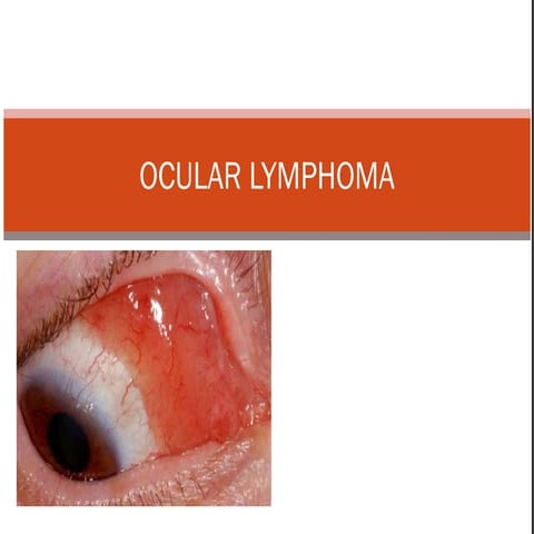 ocular lymphoma | PPT
