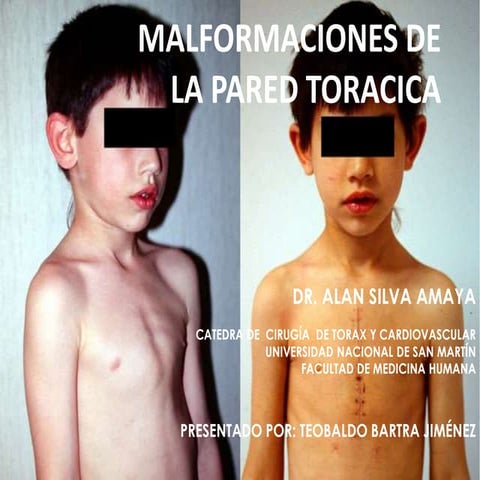 Tipos de torax | PPTX