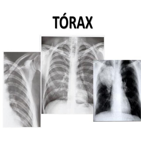 RAIO X DE TORAX | PDF