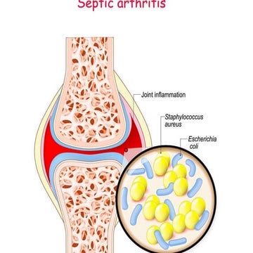 septic arthritis-1.pptx