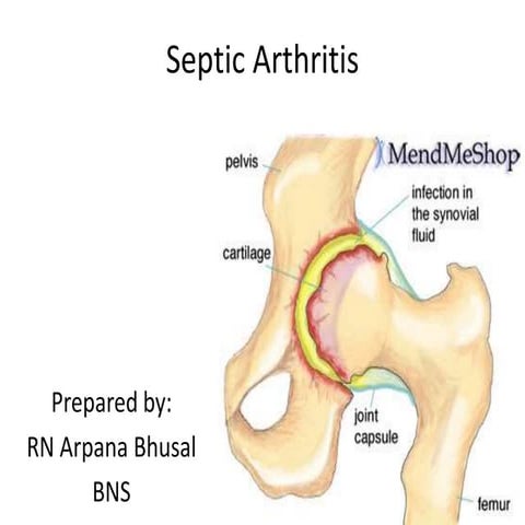 Septic Arthritis | PPTX | Bone and Joint Conditions | Diseases and Conditions