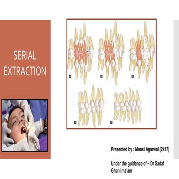 serial extraction pedo (1).pptx