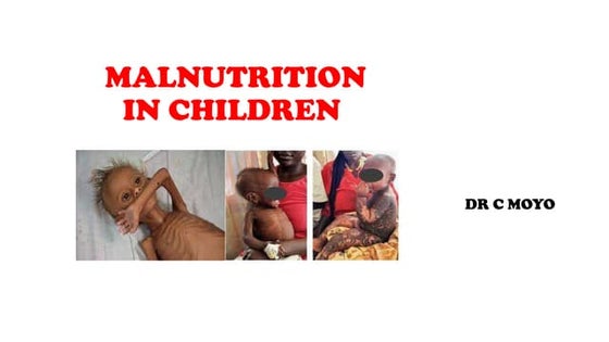 SEVERE ACUTE MALNUTRITION Pediatrics.pptx