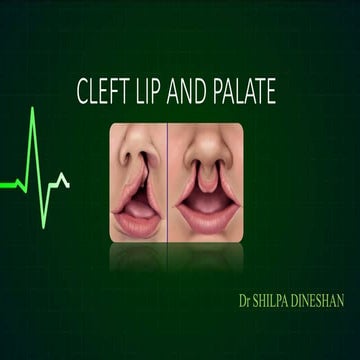 Cleft Lip And Palate Diagram