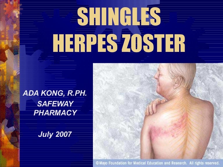 Shingles Causes Symptoms And Complications 3ff