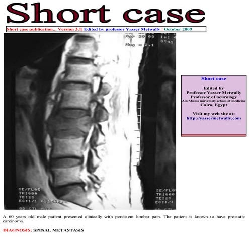 Short case...Spinal multiple sclerosis | PDF
