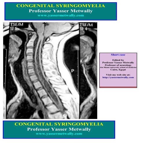 Short case...Congenital syringomyelia | PDF