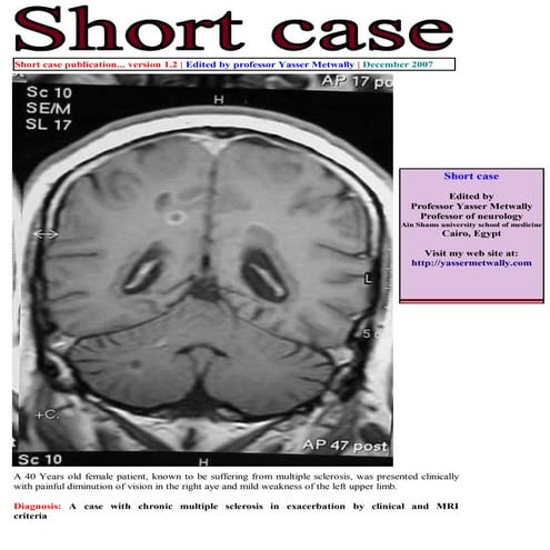 Short case...Multiple sclerosis | PDF