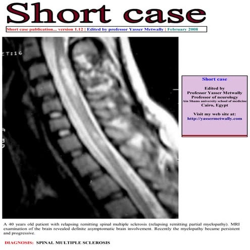 Short case...Spinal multiple sclerosis | PDF