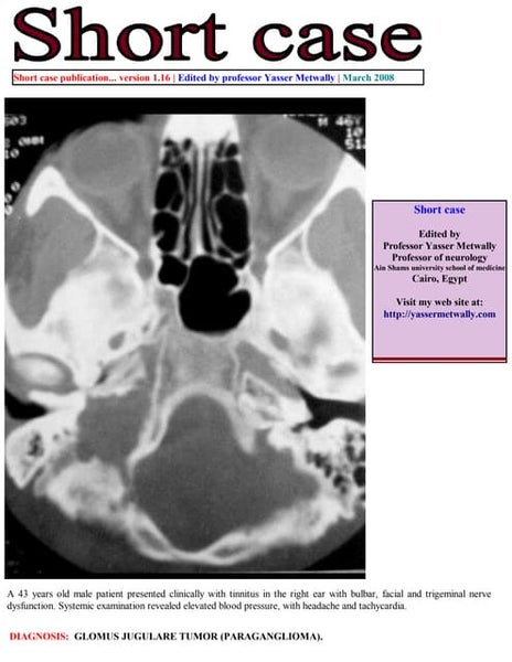 Issues In Brain Mappingpolymorphic Delta Activity And Its Brainmap