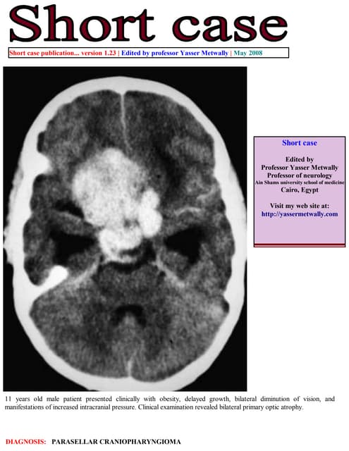 Short case..Subacute cerebral hemorrhage | PDF | Blood Disorders ...