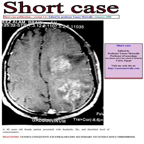 Short case..Subacute cerebral hemorrhage | PDF