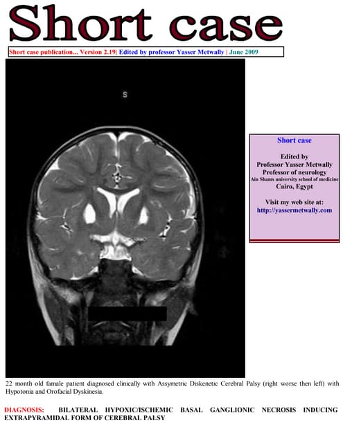 Short case..Subacute cerebral hemorrhage | PDF | Blood Disorders ...