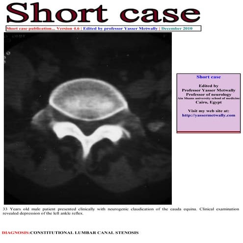 Short case...Lumbar canal stenosis | PDF