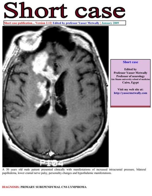 Short case..Subacute cerebral hemorrhage | PDF