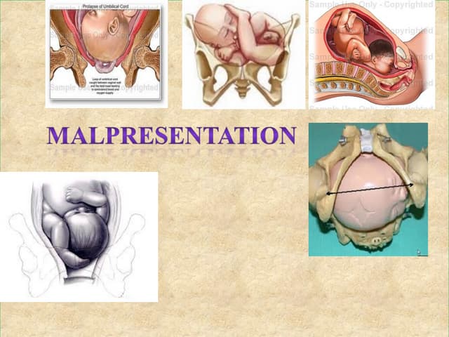 Malpresentation (face, brow) | PPTX
