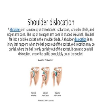 Shoulder dislocation.pptx