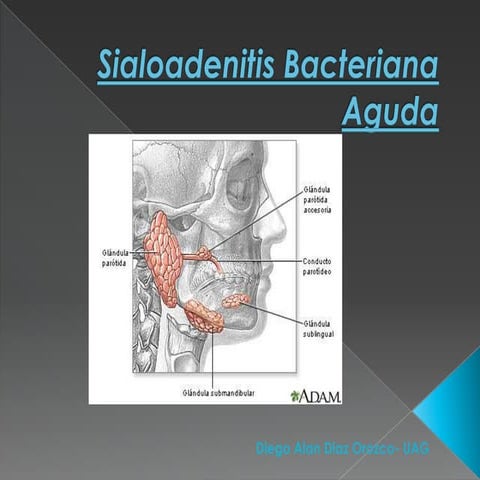 Sialoadenitis bacteriana aguda | PPTX