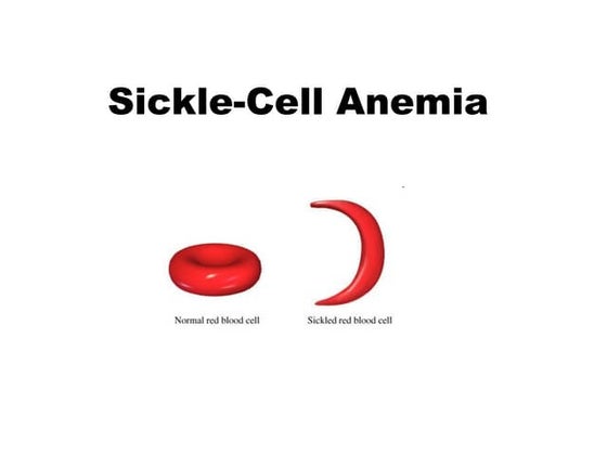Sickle cell anemia presentation | PPT