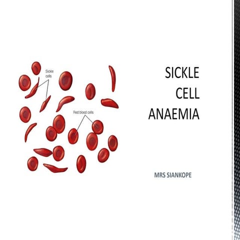 SICKLE CELL ANAEMIA ppp.pptx./ Edward Shoko | PPTX