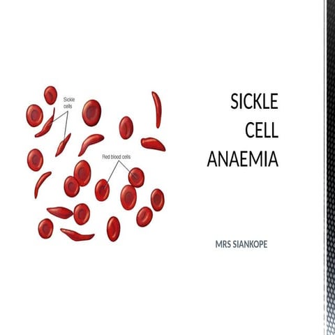 Sickle cell disease | PPTX
