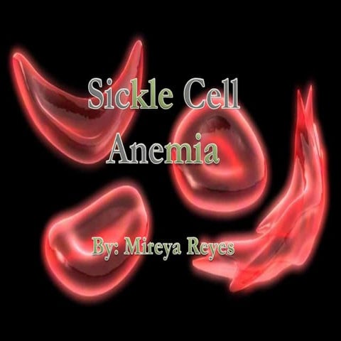 Sickle Cell Anemia | PPTX