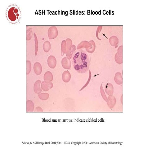 Sickle Cell Anemia (SCA) smear presentation | PPT