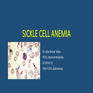 SICKLE CELL ANEMIA: Clinical features, pathophysiology and management.pptx