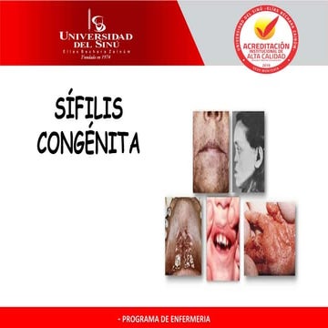 Sifilis congenita | PPTX