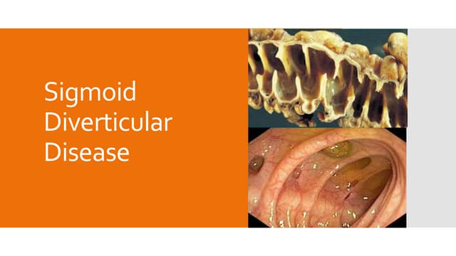 Diverticulitis | PPT