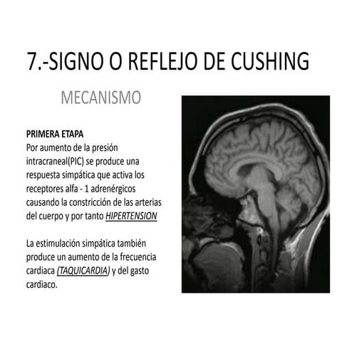 Signo o reflejo de cushing | PPT