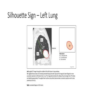 Silhouette Sign left lung | PPTX