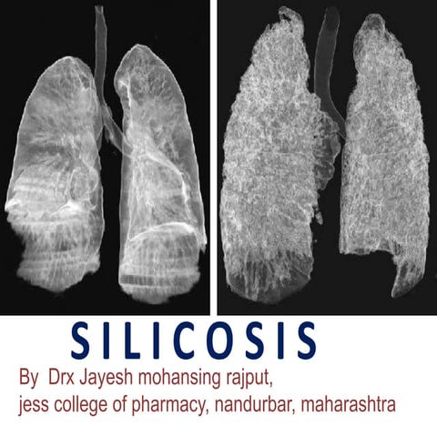 Silicosis by jayesh rajput | PPT