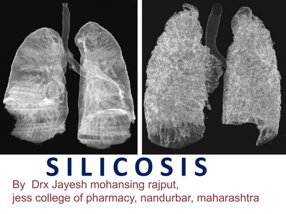 Silicosis disease | PPT