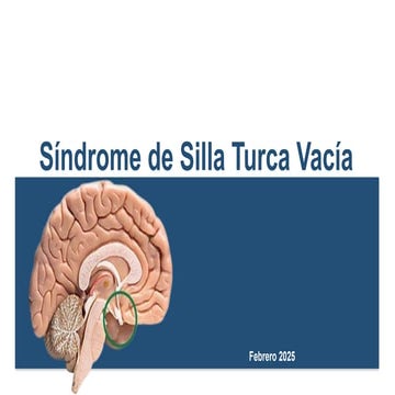 Síndrome de la silla turca: diagnóstico y manejo | PPTX