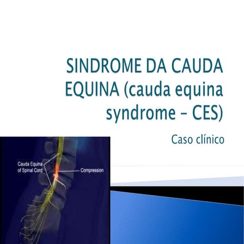 Sindrome da cauda equina (cauda equina syndrome | PPT